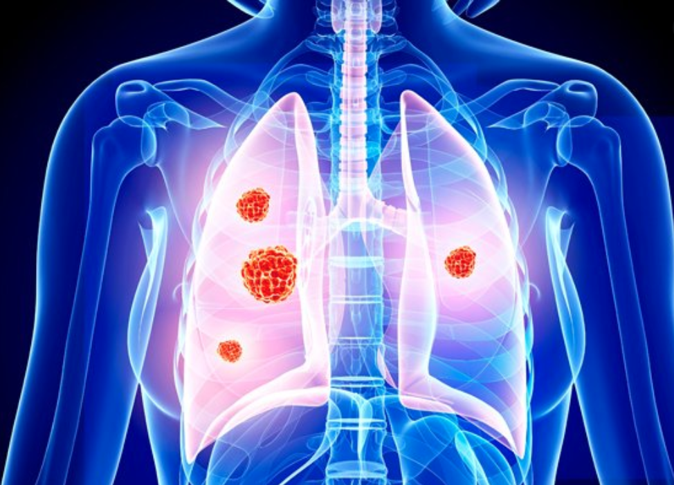 Καρκίνος του πνεύμονα: Οι διατροφικές επιλογές που αυξάνουν τον κίνδυνο ...
